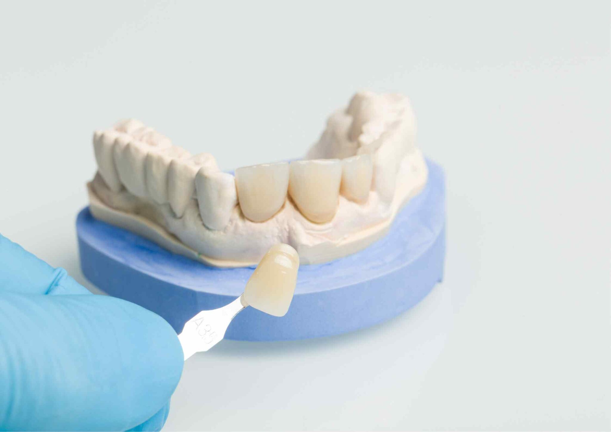 How to Close a Gap in Your Teeth Without Braces?