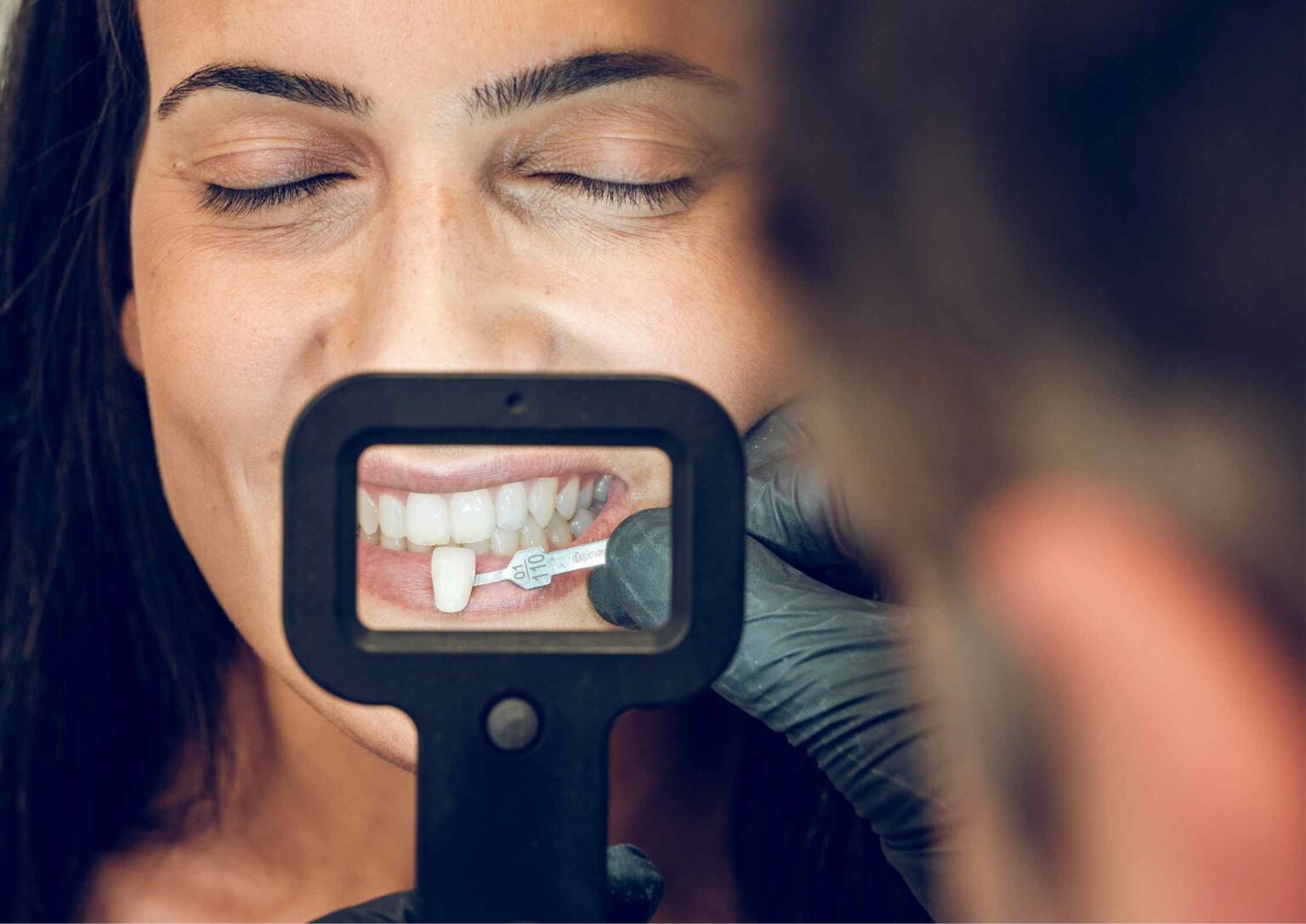 5 Types of Veneers: Your Guide to Dental Veneer Options