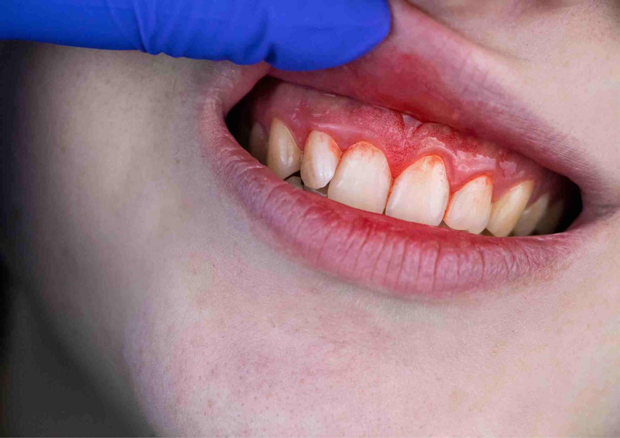 Best Floss for Bleeding Gums: The Best Options