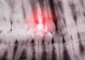 Root Canal Infection Symptoms: Recognizing Signs