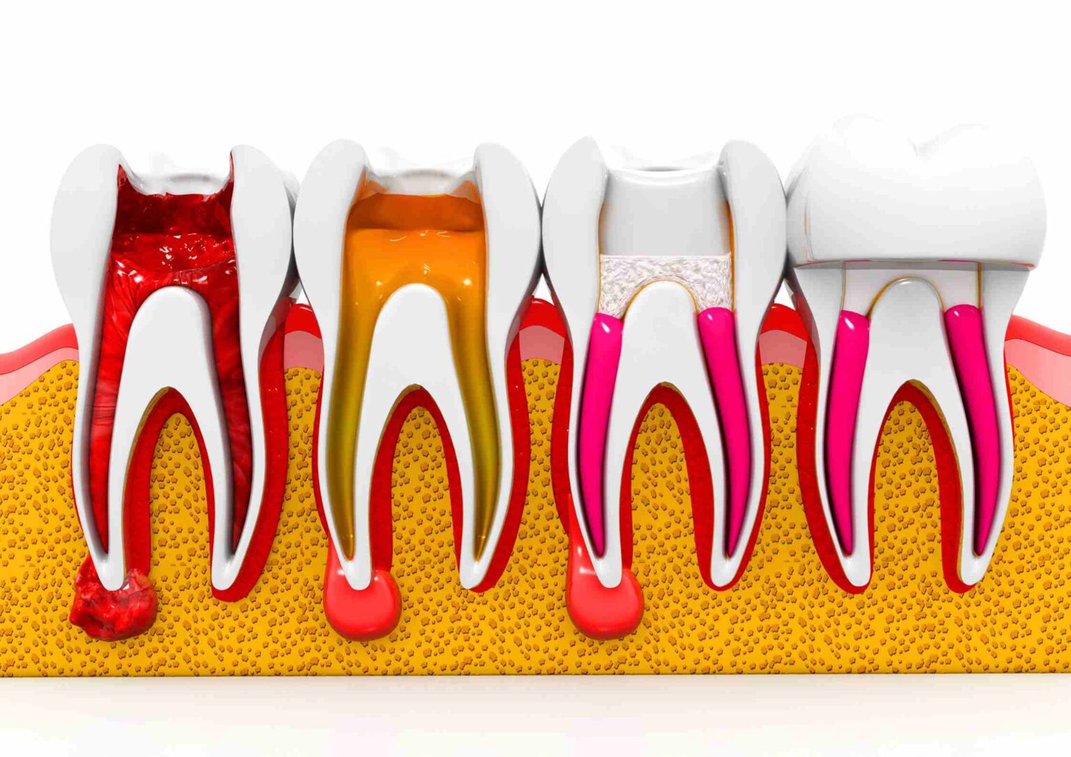 Root Canal Infection Symptoms: Recognizing Signs