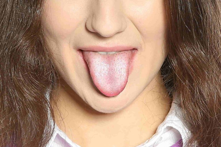 Over The Counter Oral Thrush Treatments and Medication