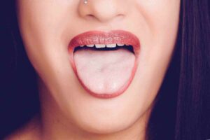 How to Get Rid of a White Tongue Permanently?