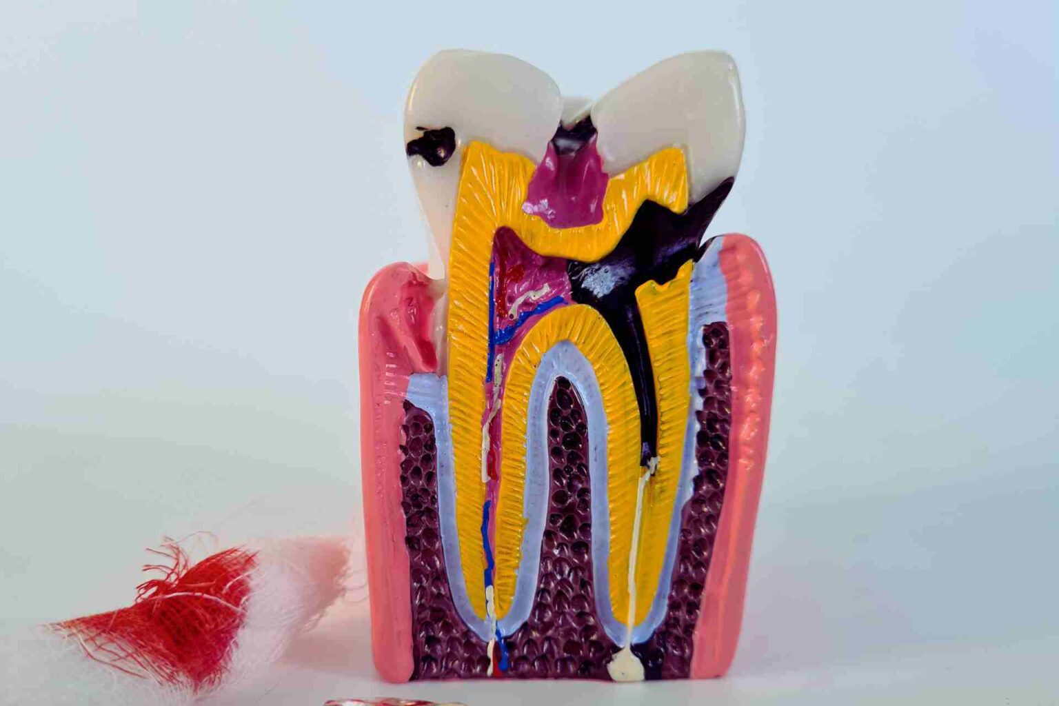 Tooth Decay Under Crown Black Color - Joyce The Dentist