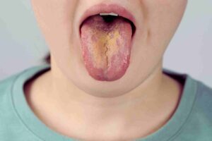 Persistent Oral Thrush in Adults: Causes, Symptoms, and Solutions
