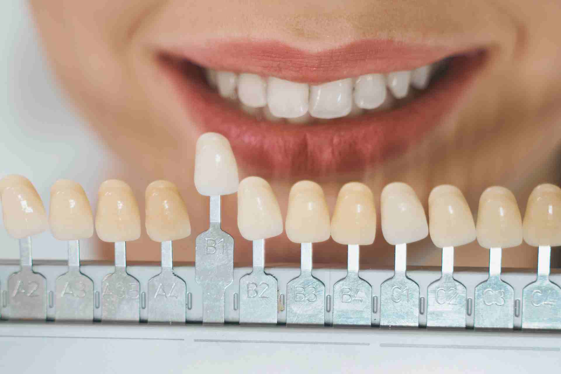 What Happens to Teeth Under Veneers?