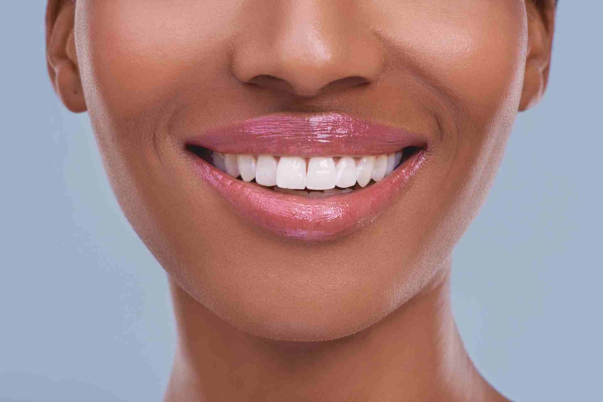 Composition of Veneers: What You Need to Know