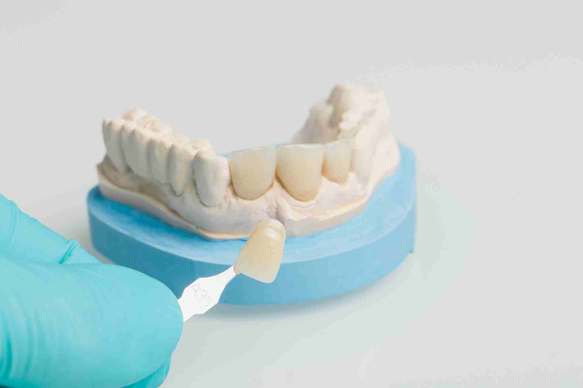 Composition of Veneers: What You Need to Know