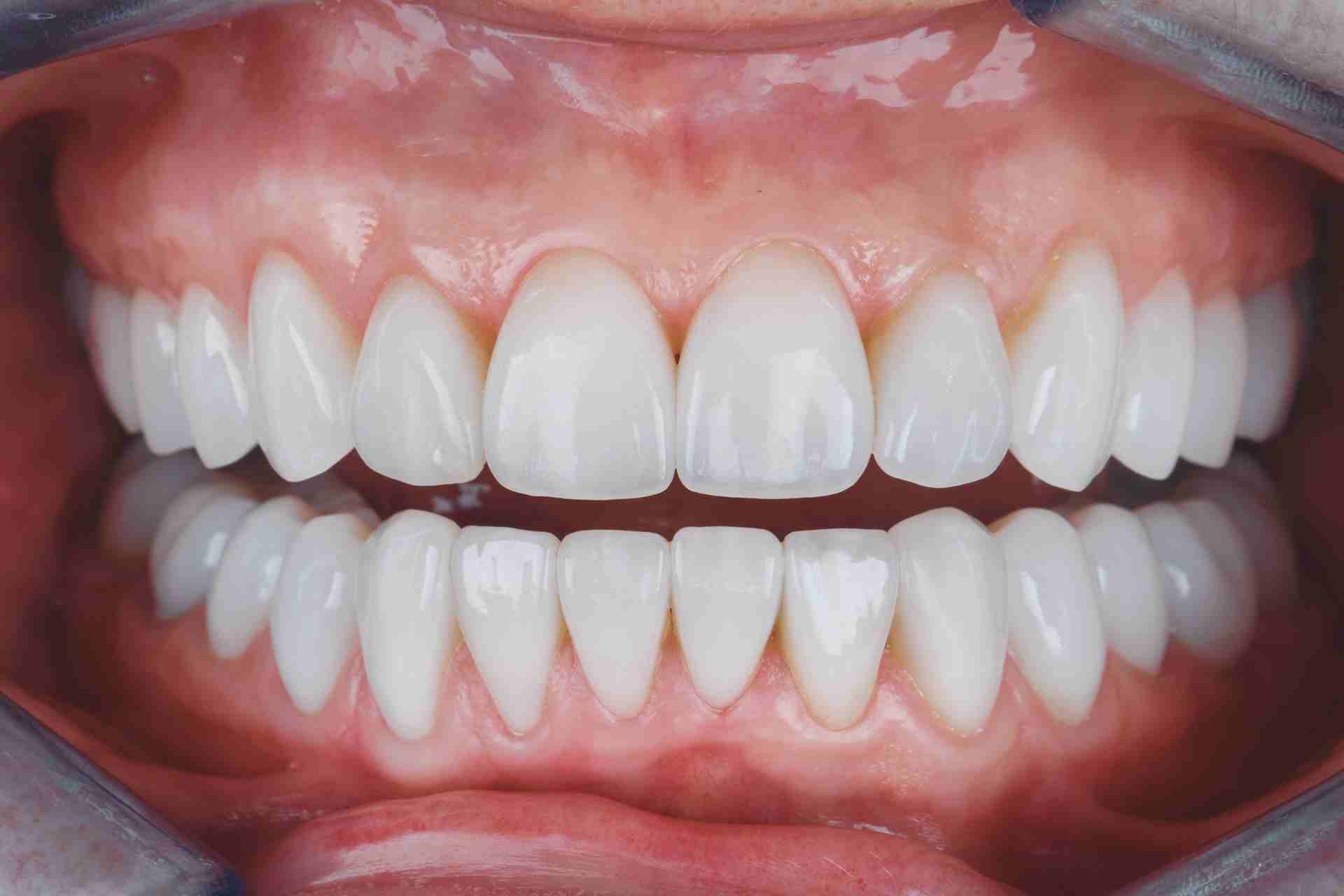 Composition of Veneers: What You Need to Know