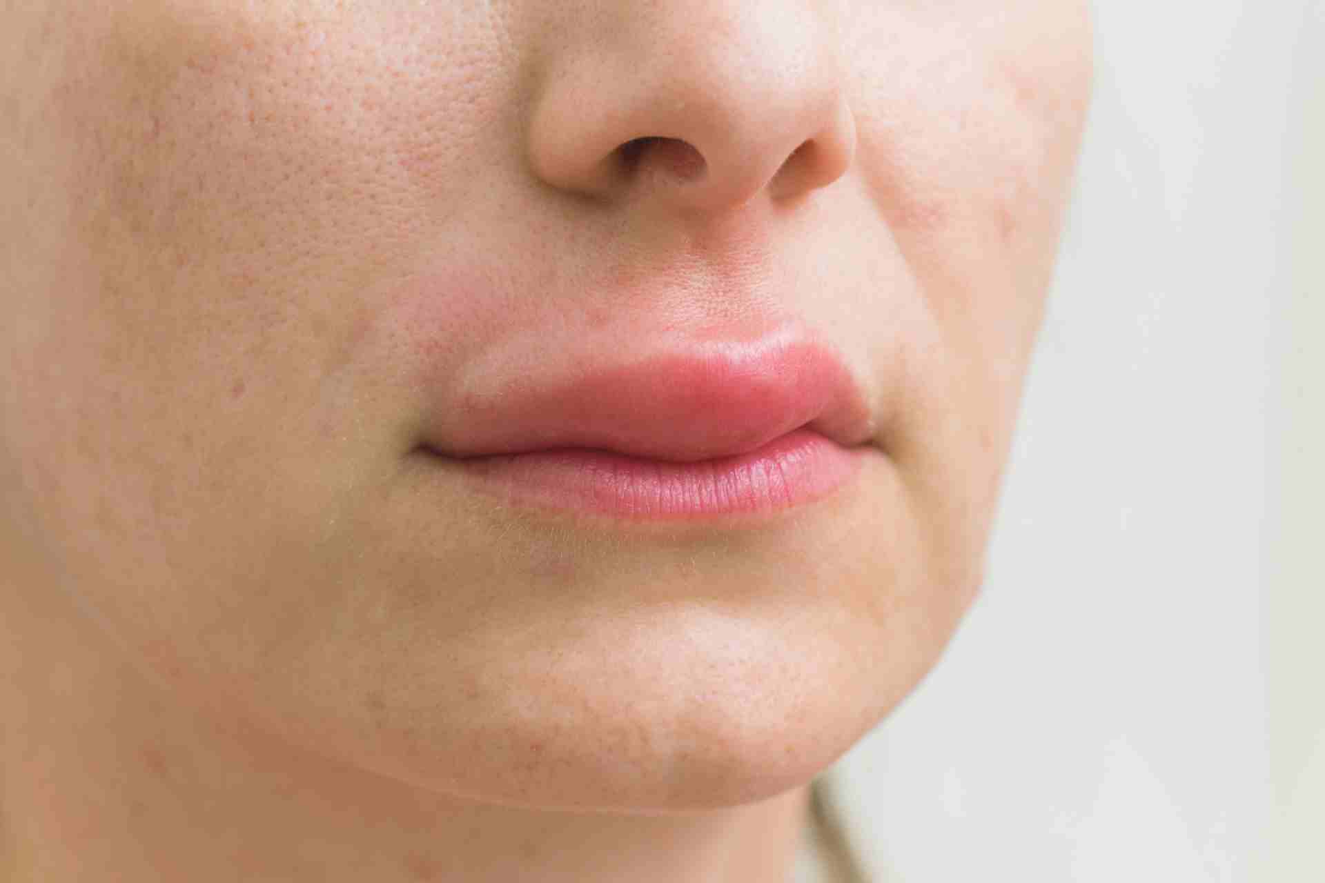 Why Do I Have A Tiny Bump On My Lip? 8 Reasons And Remedies