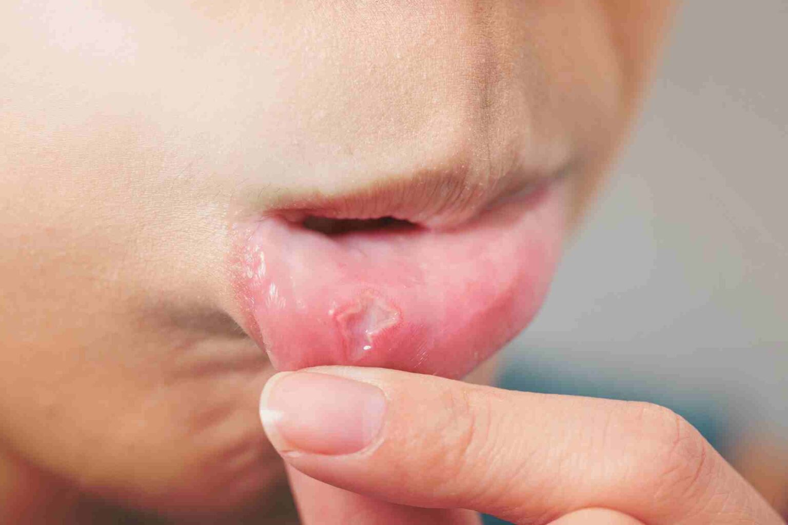 Why Do I Have A Tiny Bump On My Lip? 8 Reasons And Remedies