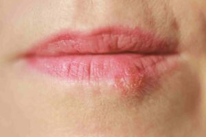 Why Do I Have A Tiny Bump On My Lip? 8 Reasons And Remedies
