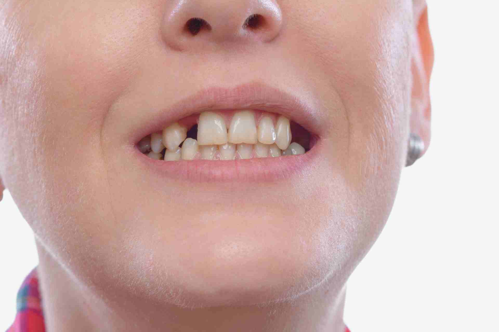 Why Do My Teeth Hurt When I Eat Sweets?