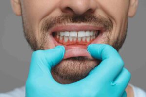 Tooth Is Loose But Still Attached What To Do