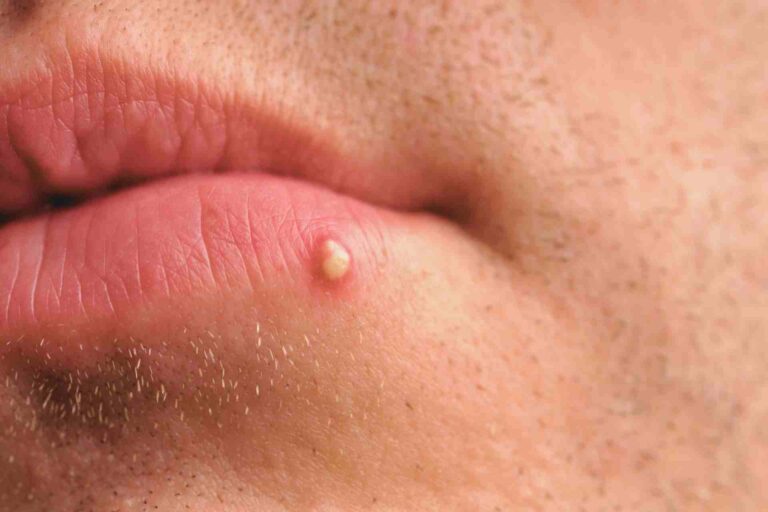Why Do I Have A Tiny Bump On My Lip? 8 Reasons And Remedies