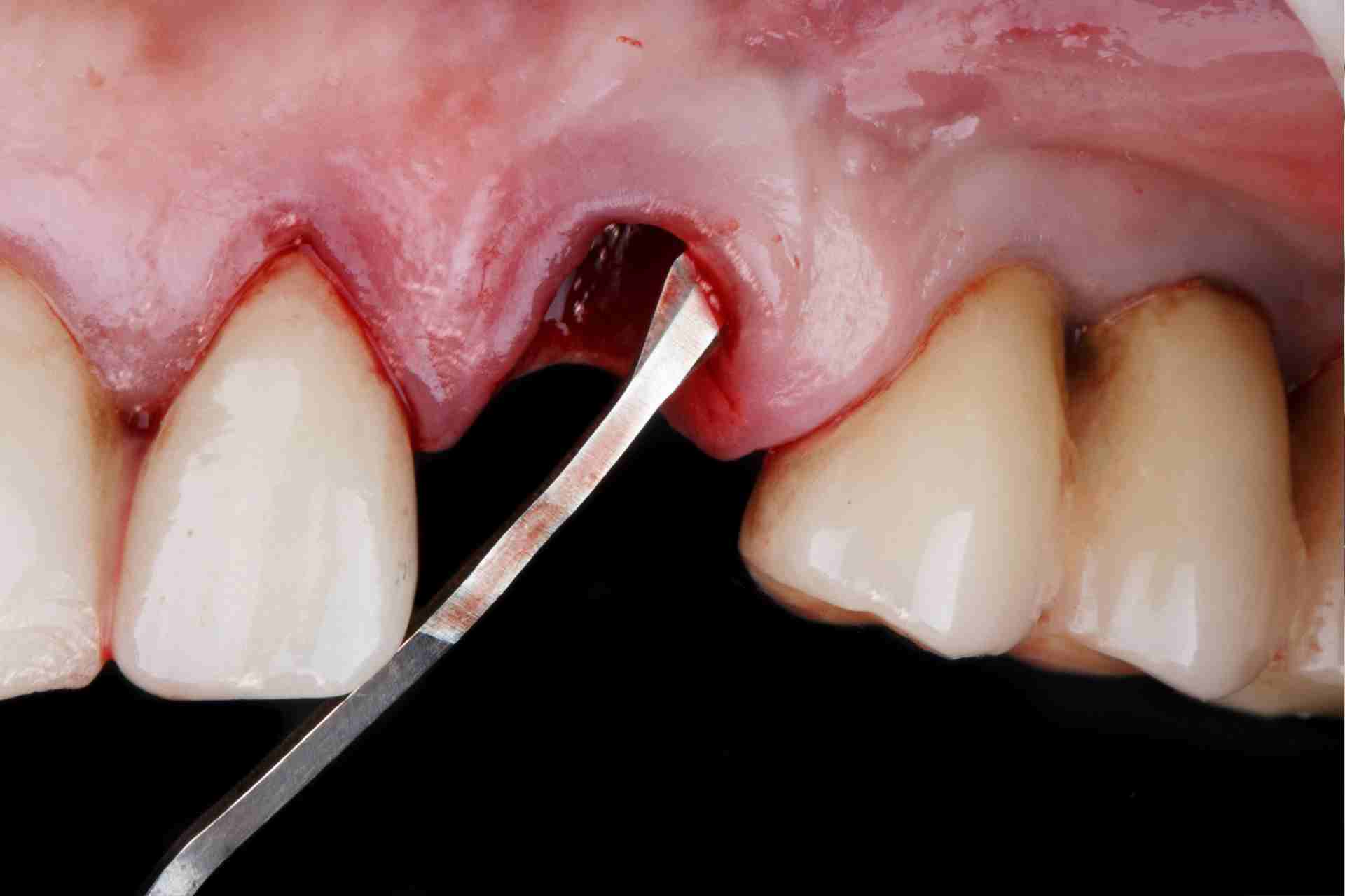 Is Your Dental Bone Graft Failing? Key Warning Signs