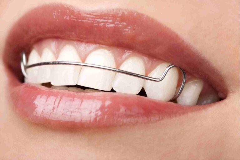 How to Floss with a Permanent Retainer: A Complete Guide