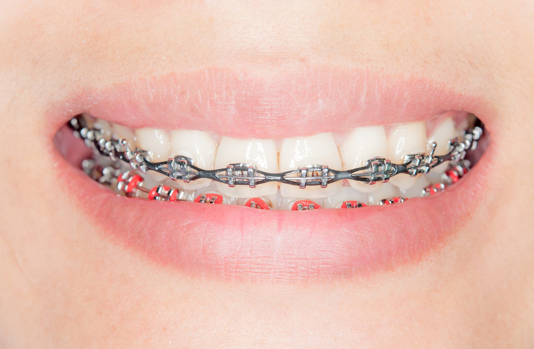 Power Chain Braces Explained: Everything You Need to Know