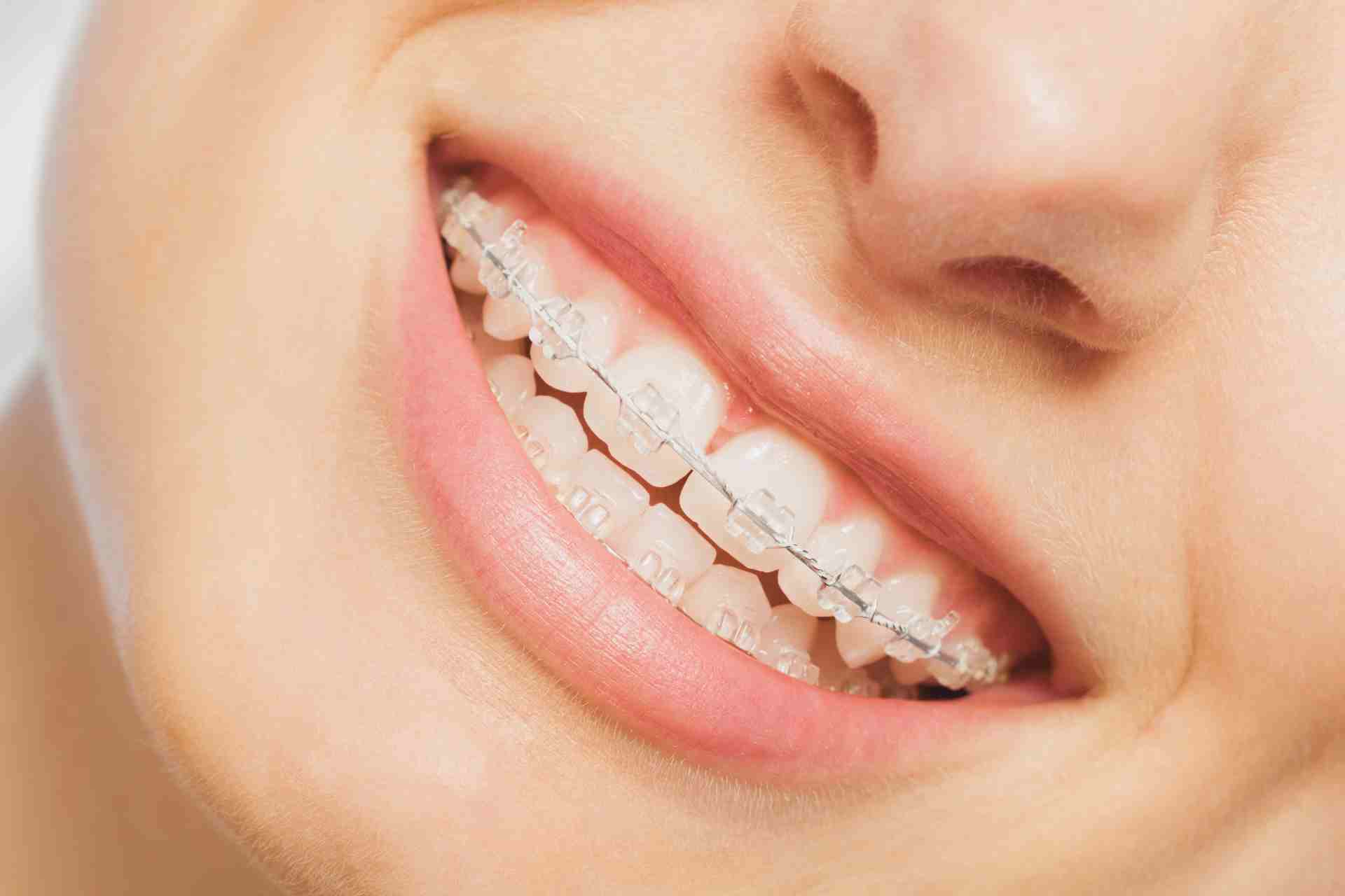 Best Braces Colors to Brighten Your Smile in 2025