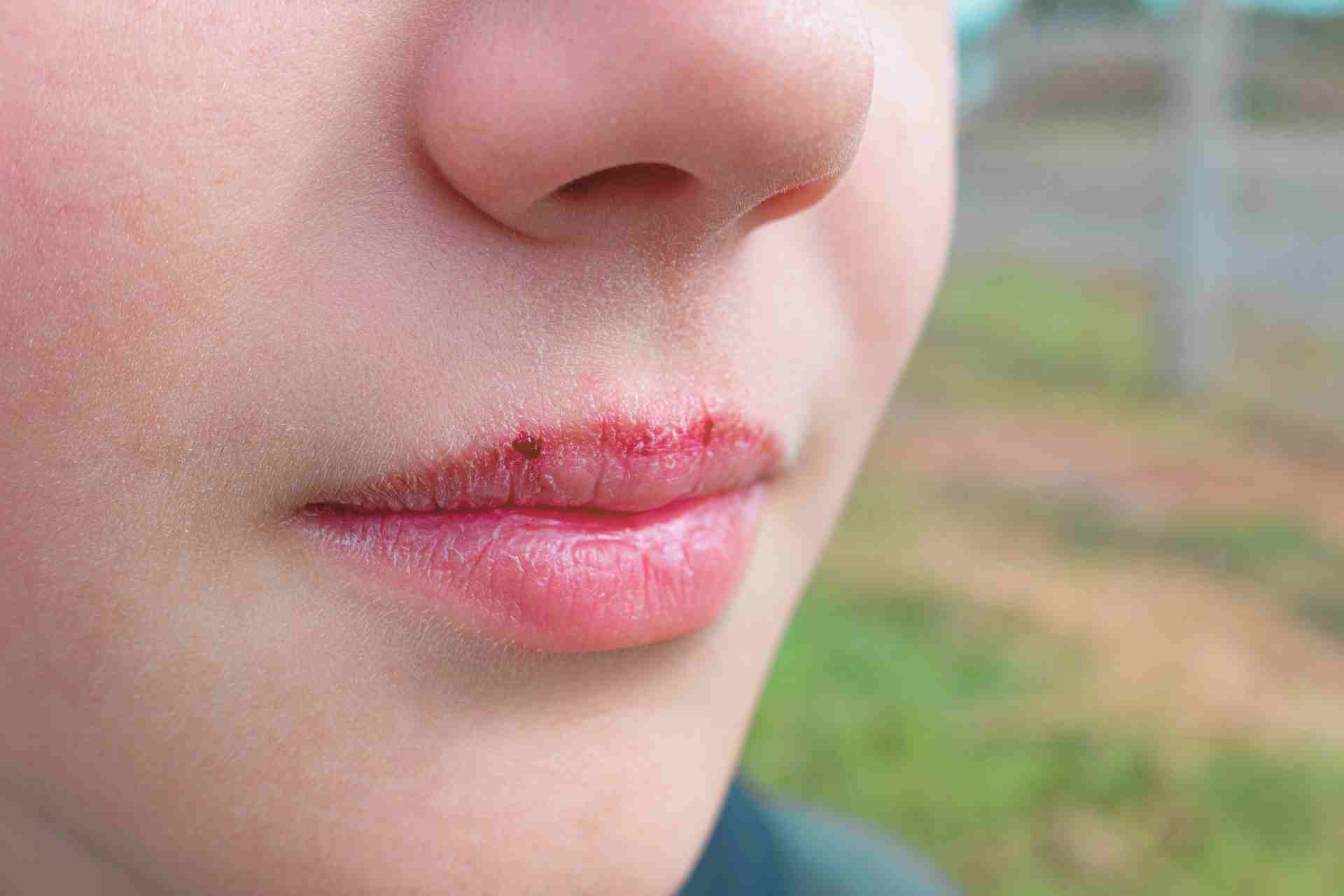 Angular Cheilitis Treatment: Relief for Cracked Mouth Corners