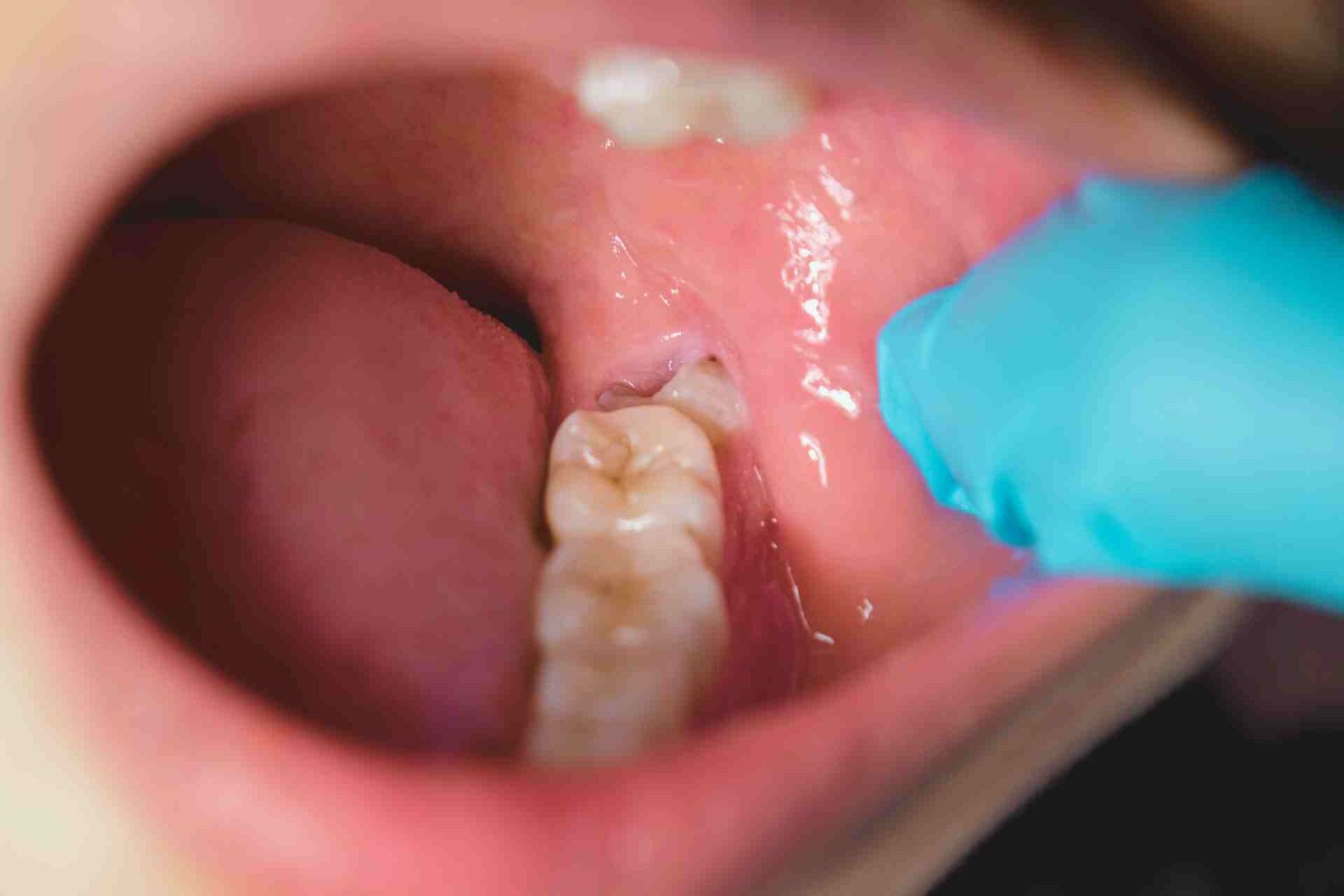 When Do Wisdom Teeth Come In? Signs, Timing & What to Expect