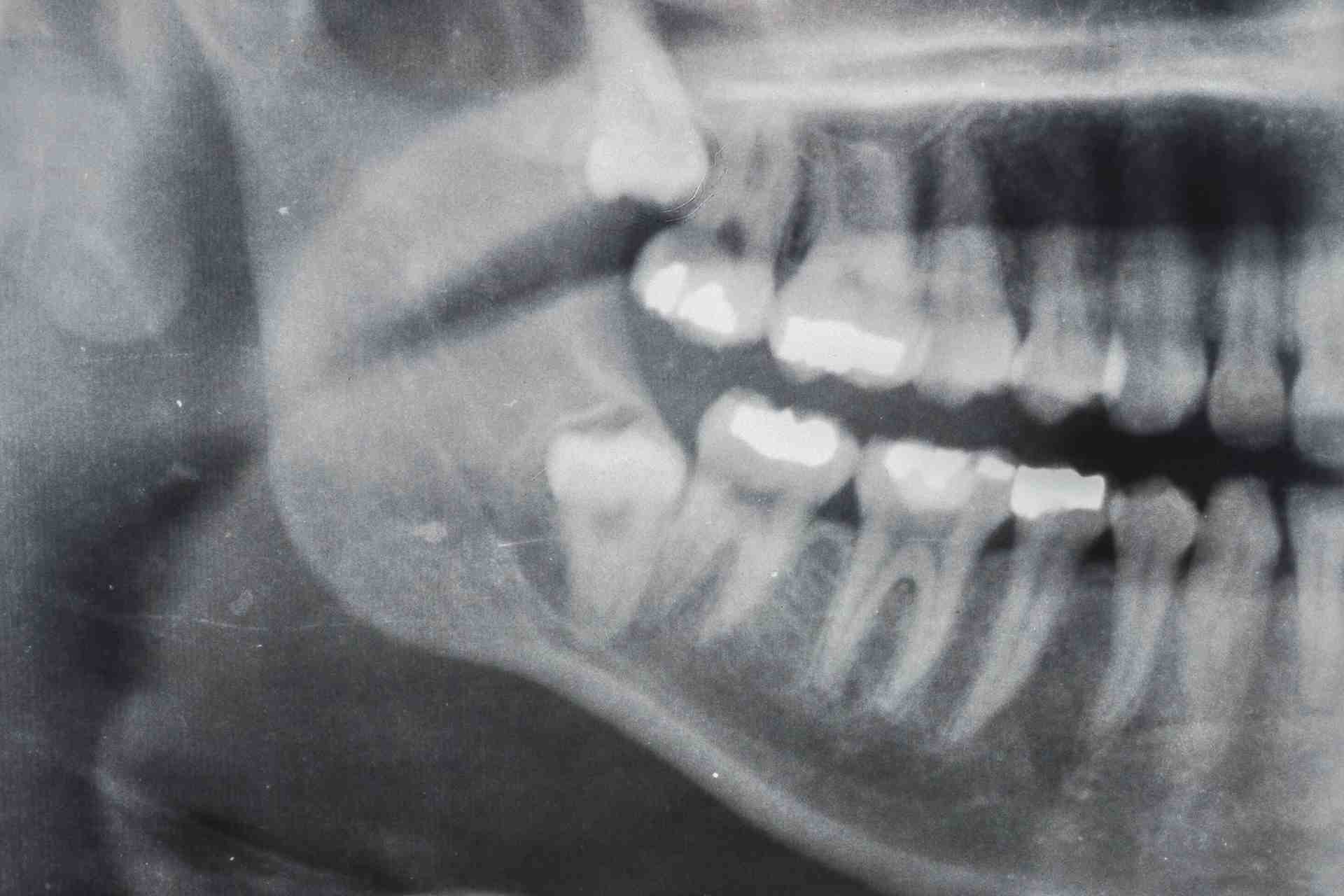 When Do Wisdom Teeth Come In? Signs, Timing & What to Expect