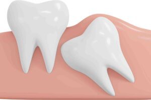 When Do Wisdom Teeth Come In? Signs, Timing & What to Expect